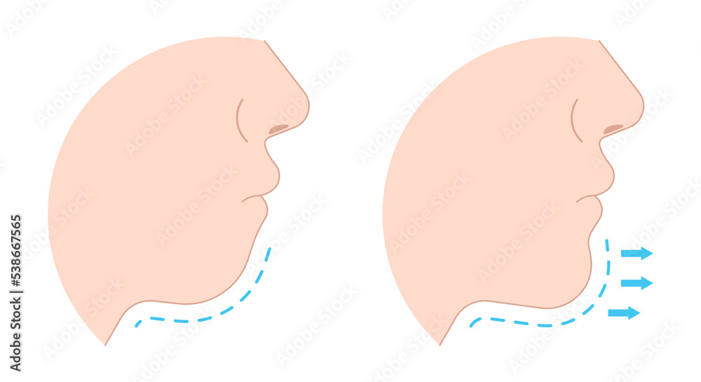 chin augmentation with rhytidectomy Orthodontist Temporomandibular ...