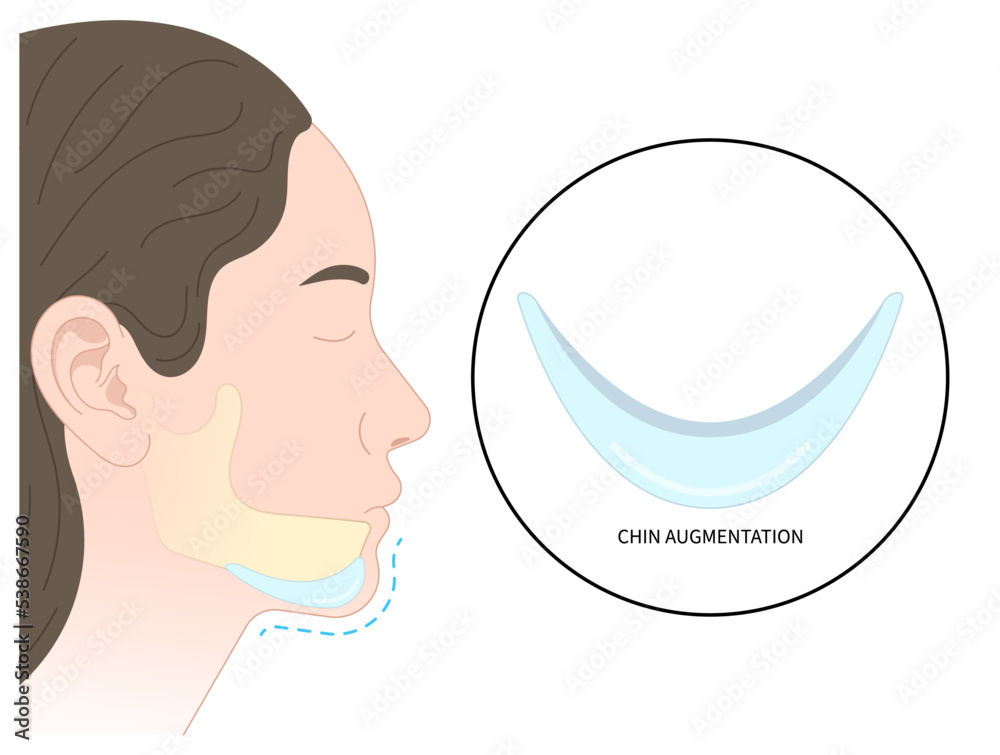 chin augmentation with rhytidectomy Orthodontist Temporomandibular ...