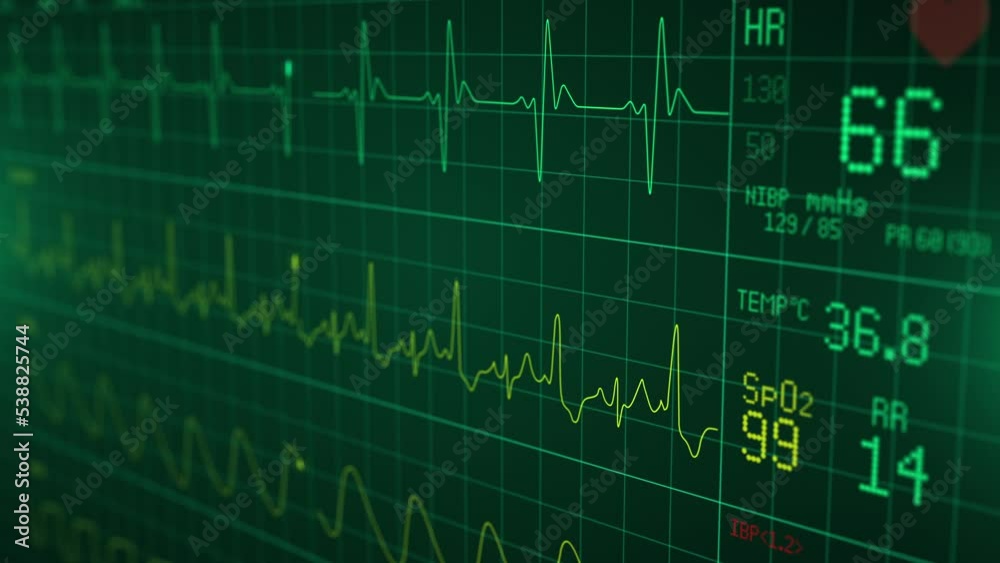 Vidéo Stock Patient monitor displays vital signs ECG electrocardiogram ...