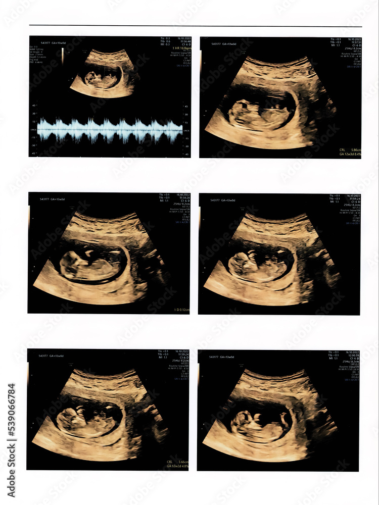 ultrasound images of 13 weeks pregnant show baby or fetus development ...