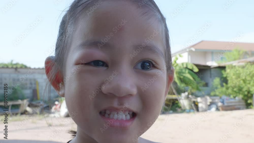 Stye Eye diseases. Closed Asian kid little girl eye with sty, eyelid ...
