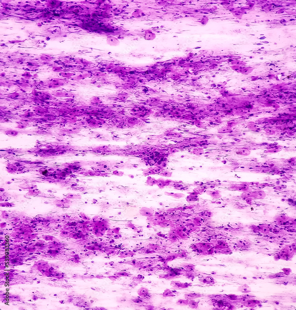 Pap's smear, microscopic 40x show high-grade squamous intraepithelial ...