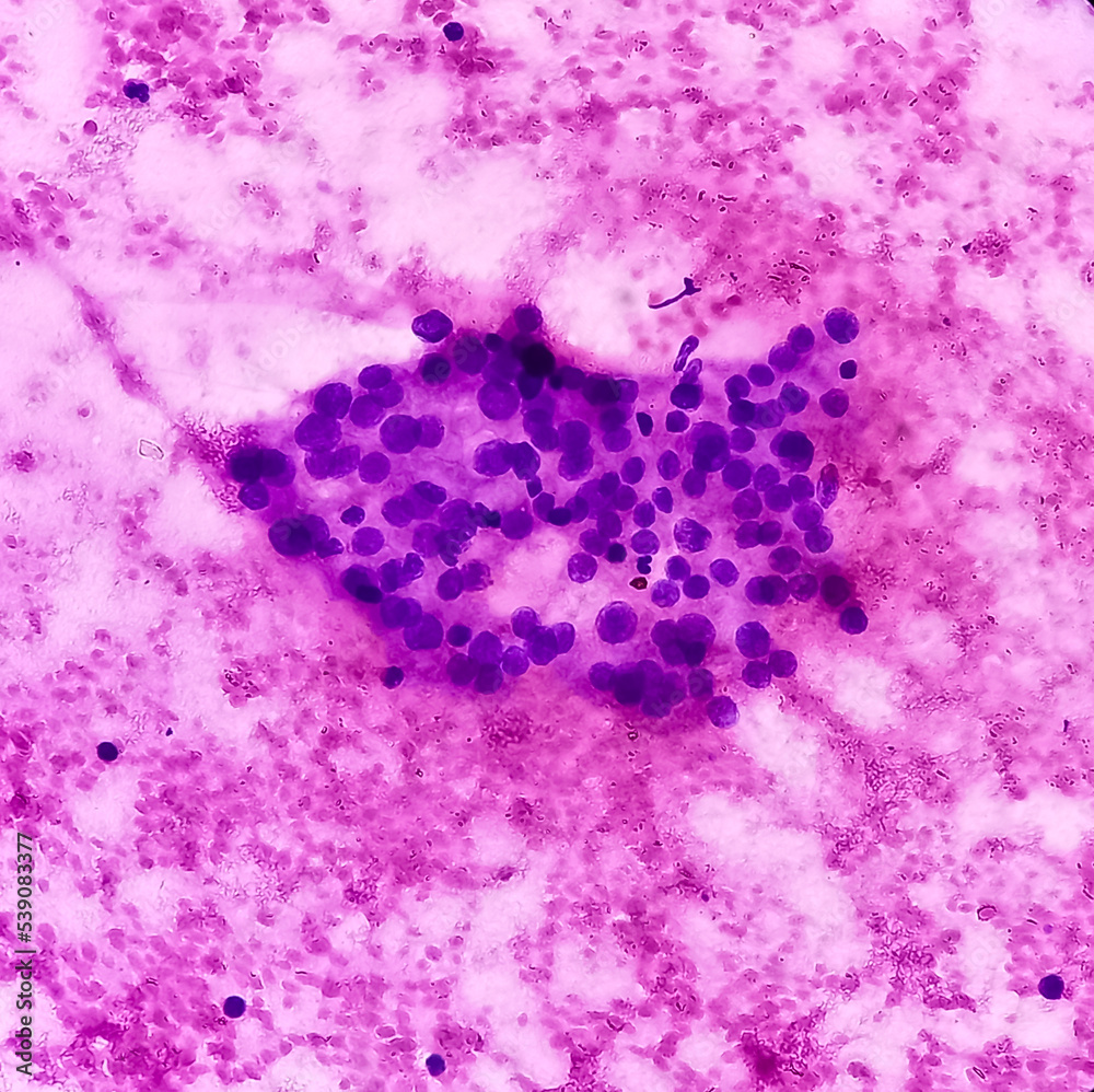 Thyroid Swelling Fna Cytology Cellular Follicular Lesion Microscopic Image Showing Regular