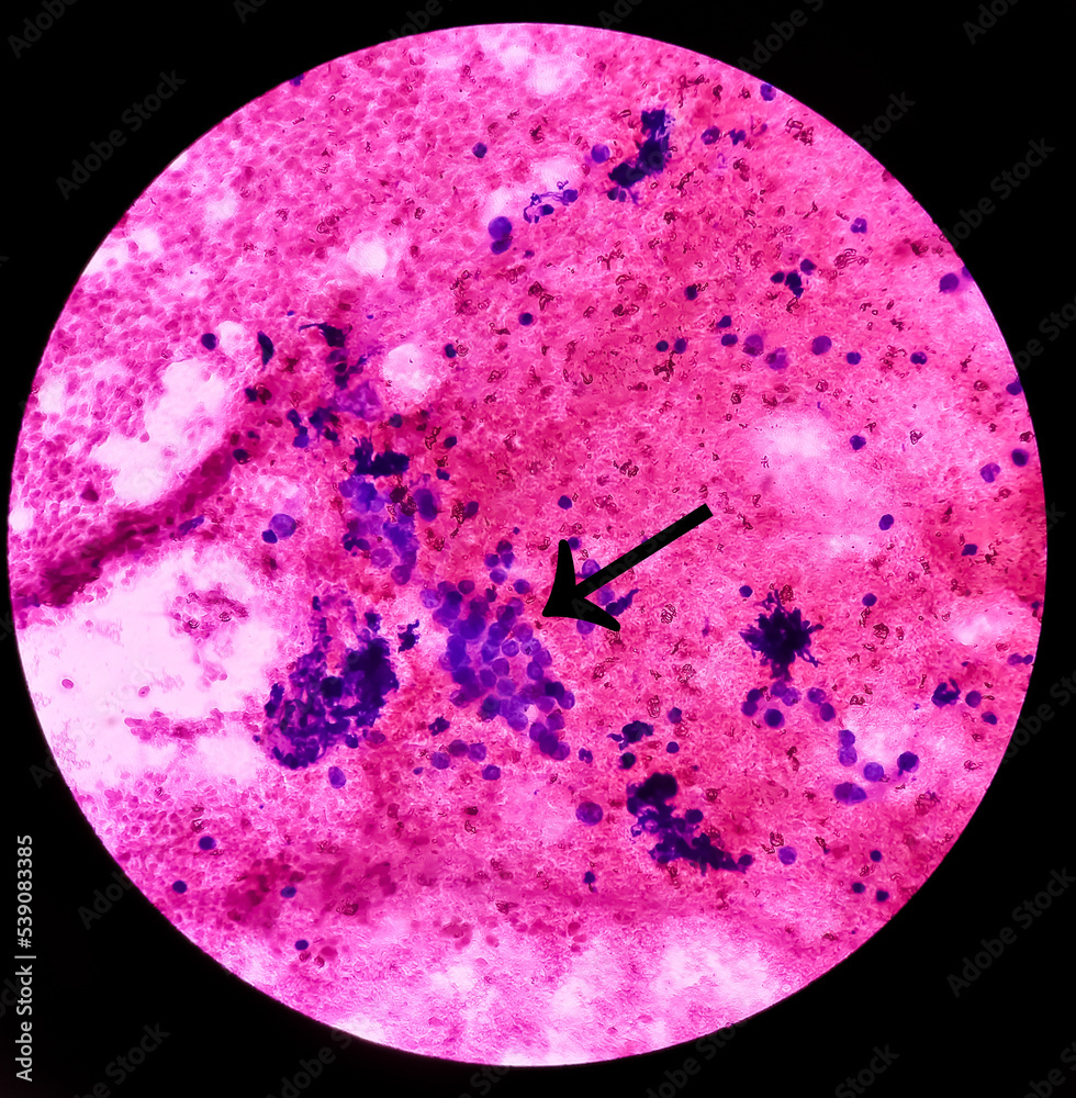 Thyroid swelling (FNA cytology): Cellular follicular lesion ...