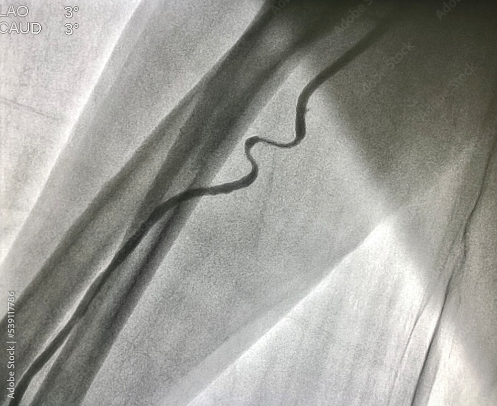 Angiogram shown tortuous right radial artery. Stock Photo | Adobe Stock