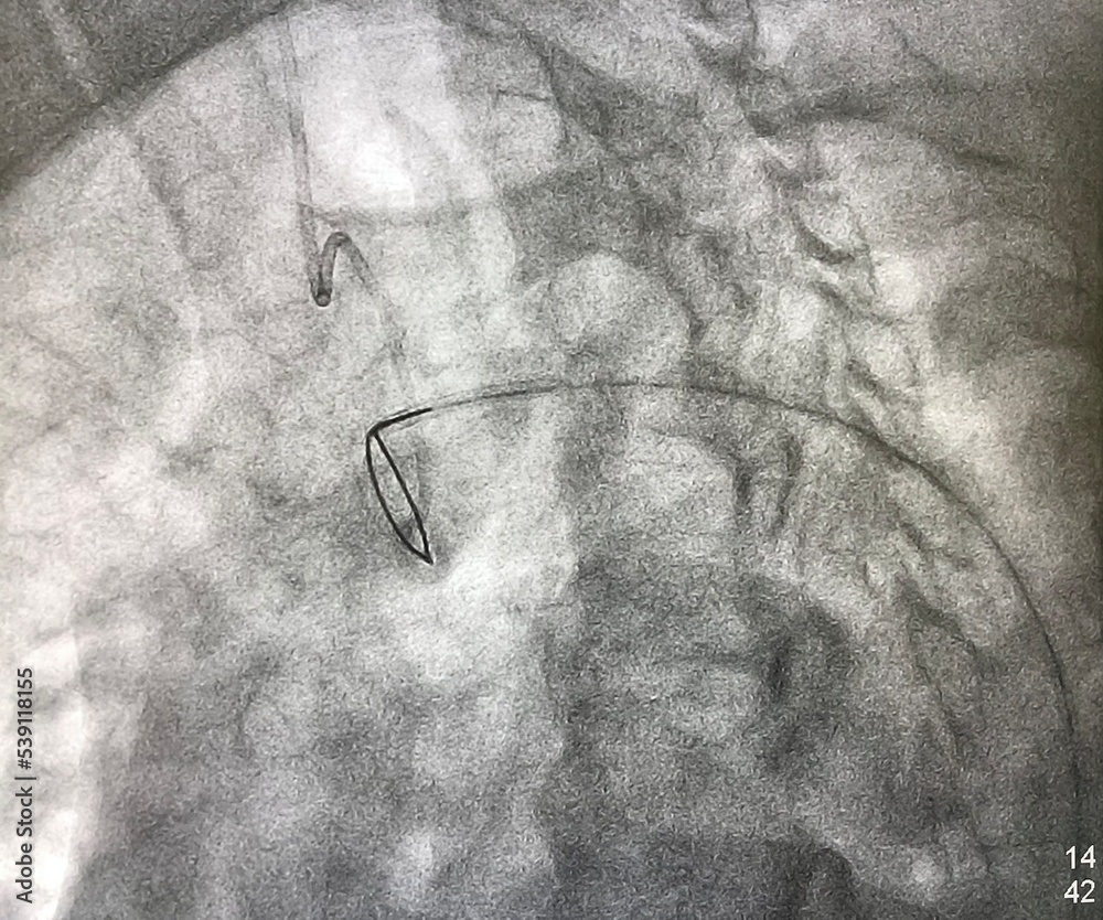 Endovascular snare catheter during cardiac catheterization. Stock Photo ...