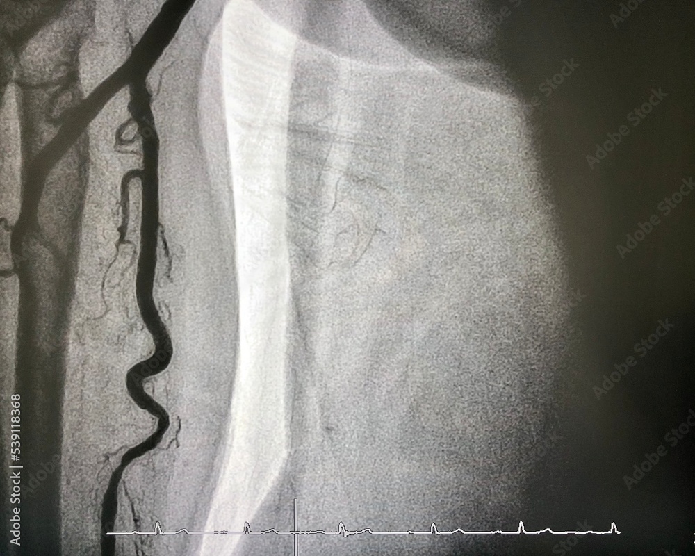 Angiogram shown tortuous right radial artery. Stock Photo | Adobe Stock