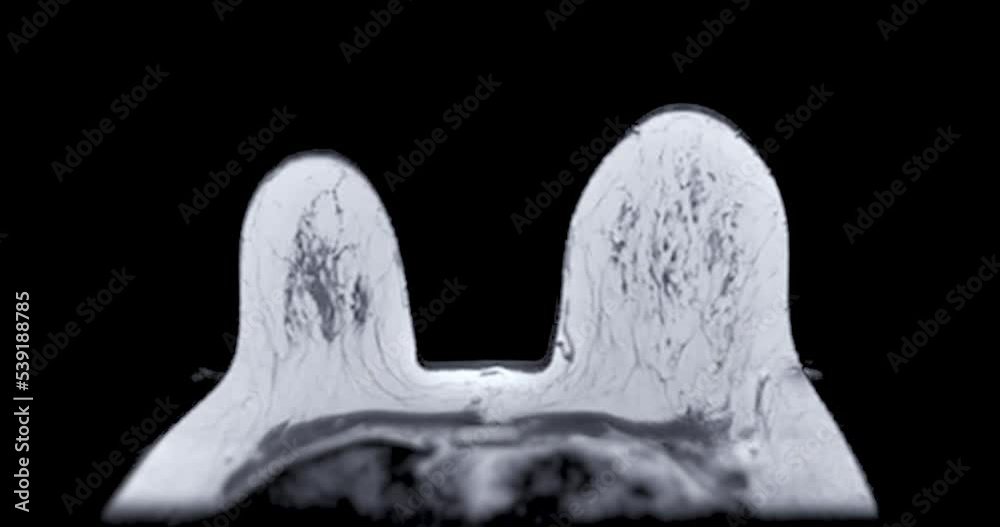 Breast MRI magnetic resonance imaging of the breast uses radio waves ...