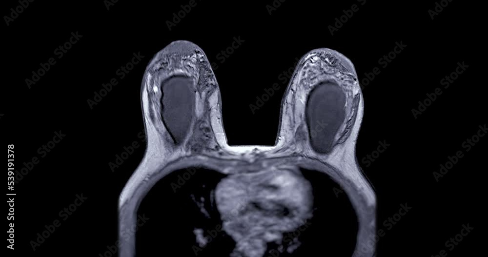 Breast MRI magnetic resonance imaging of the breast uses radio waves ...