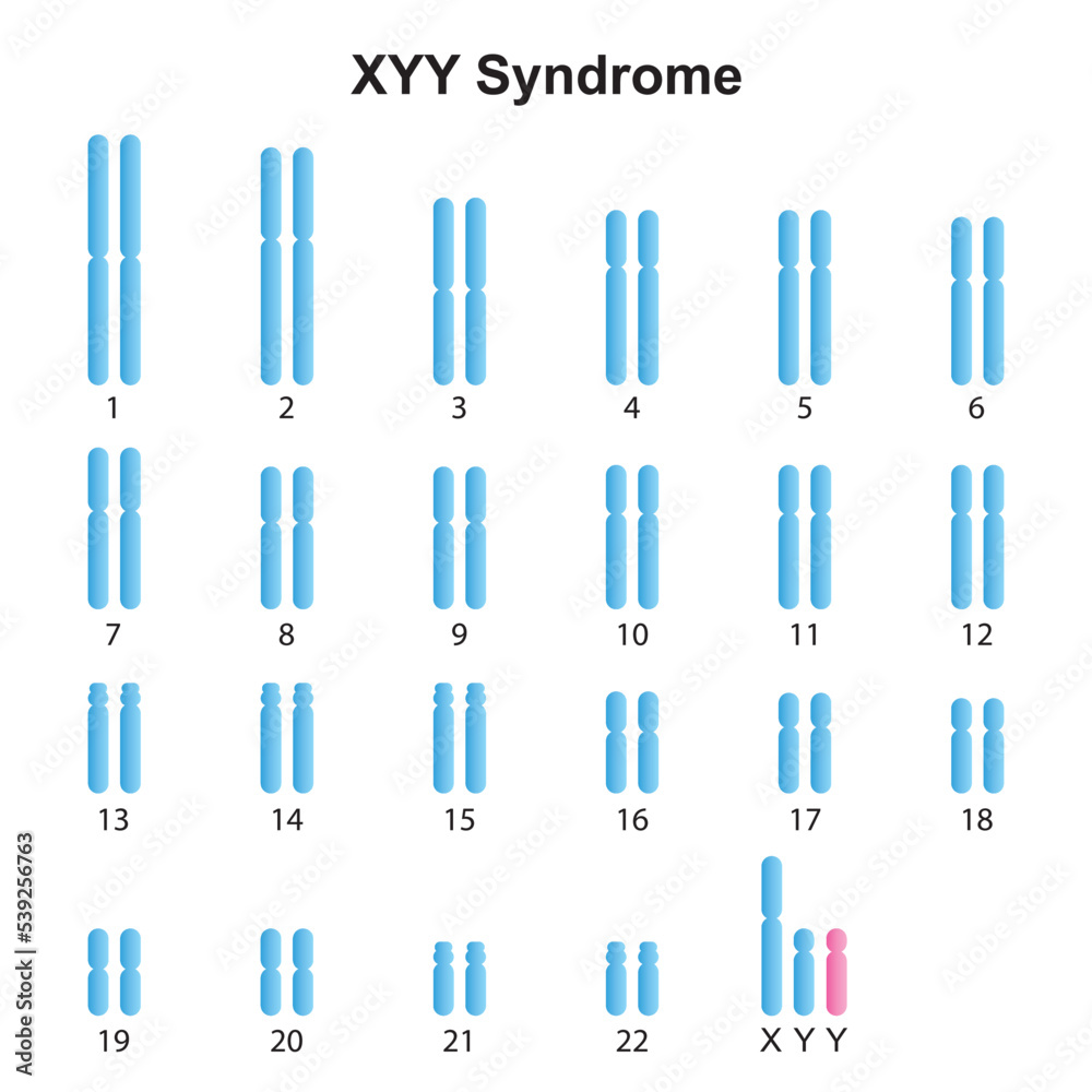 Scientific Designing of Jacobs Syndrome (XYY) Karyotype. Colorful ...