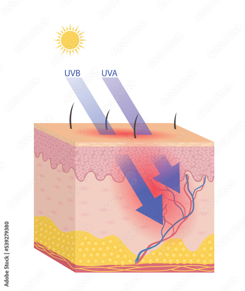 Skin care in summer. Human skin damaged by sunlight or ultraviolet ...