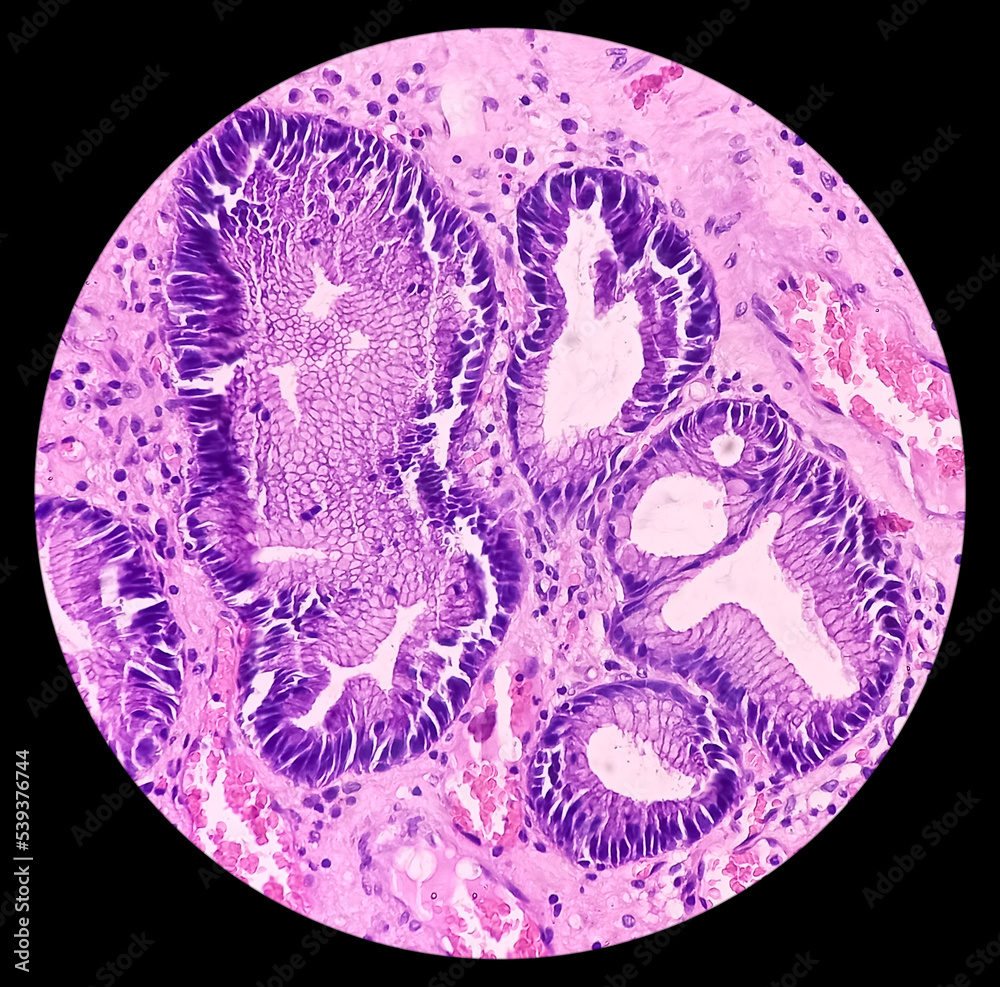 Fototapeta Gastric polyp biopsy: Adenomatous polyps. Showing gastic ...
