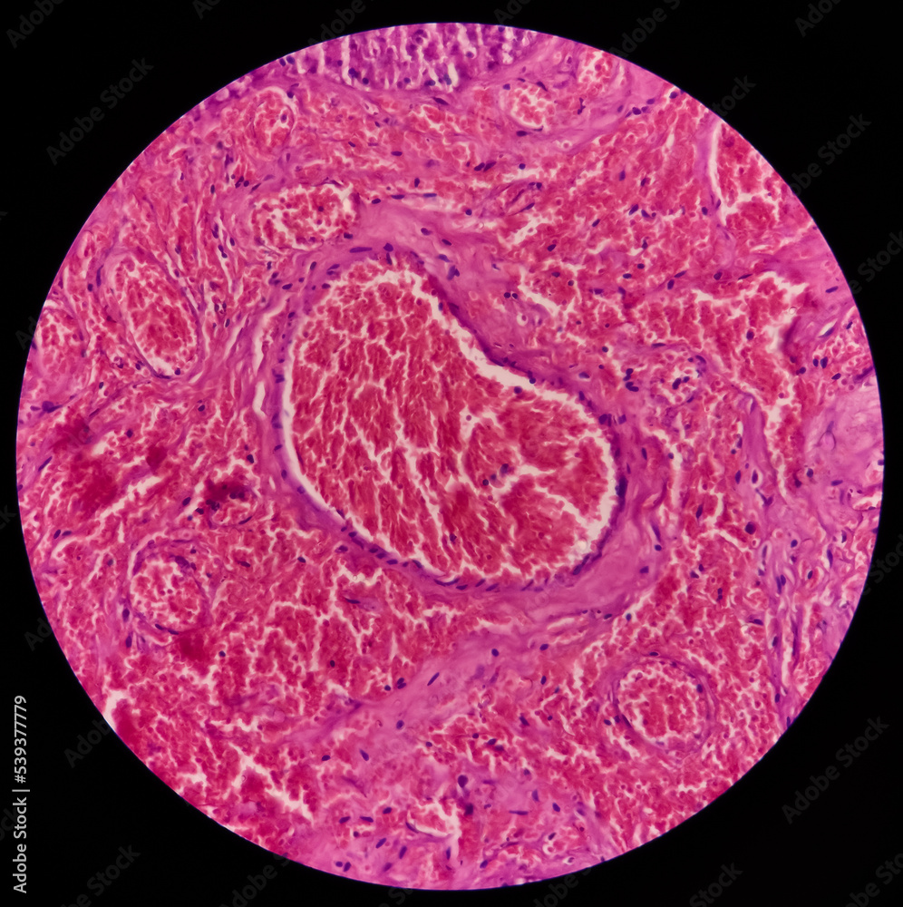 Testis Biopsy Testicular Infarction Disease Of Male Genital Organs