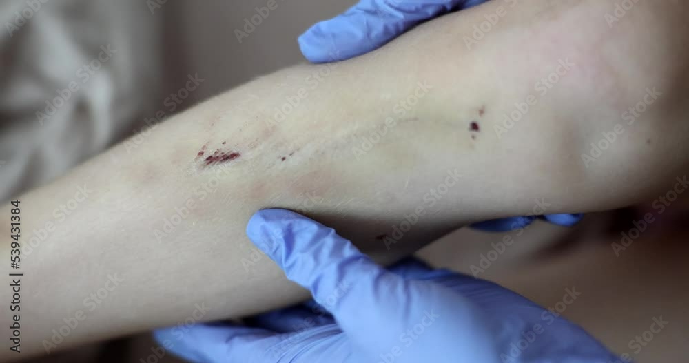 Doctor traumatologist examining leg of child with multiple abrasions ...