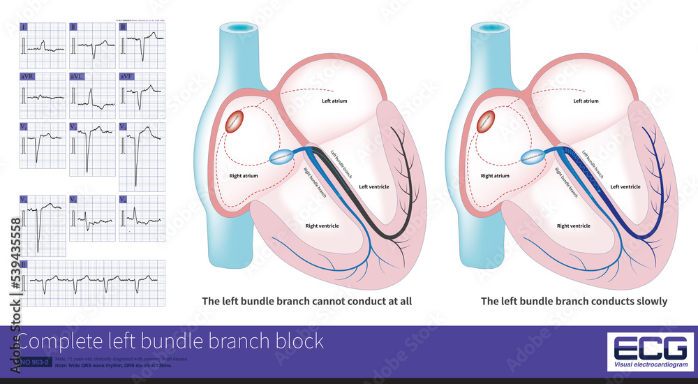 In complete left bundle branch block, the conduction of the LBB can be ...