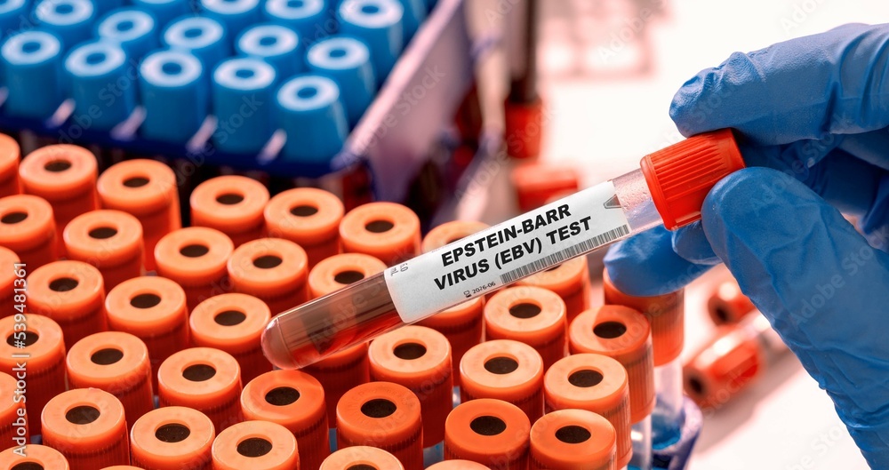 Epstein-Barr Virus (EBV) Test tube with blood sample in infection lab ...