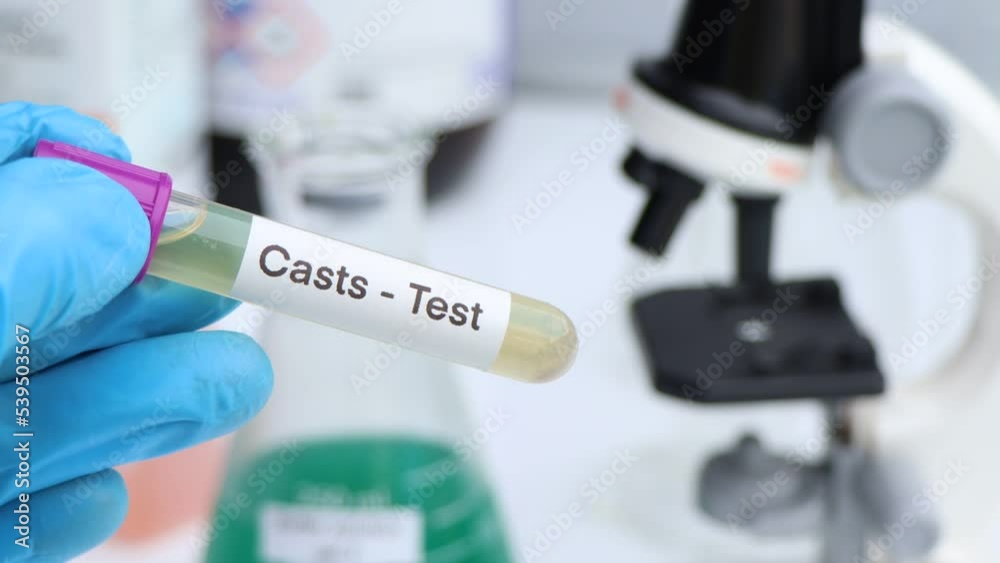 Urine samples for testing Casts in the laboratory, urine sample in test ...