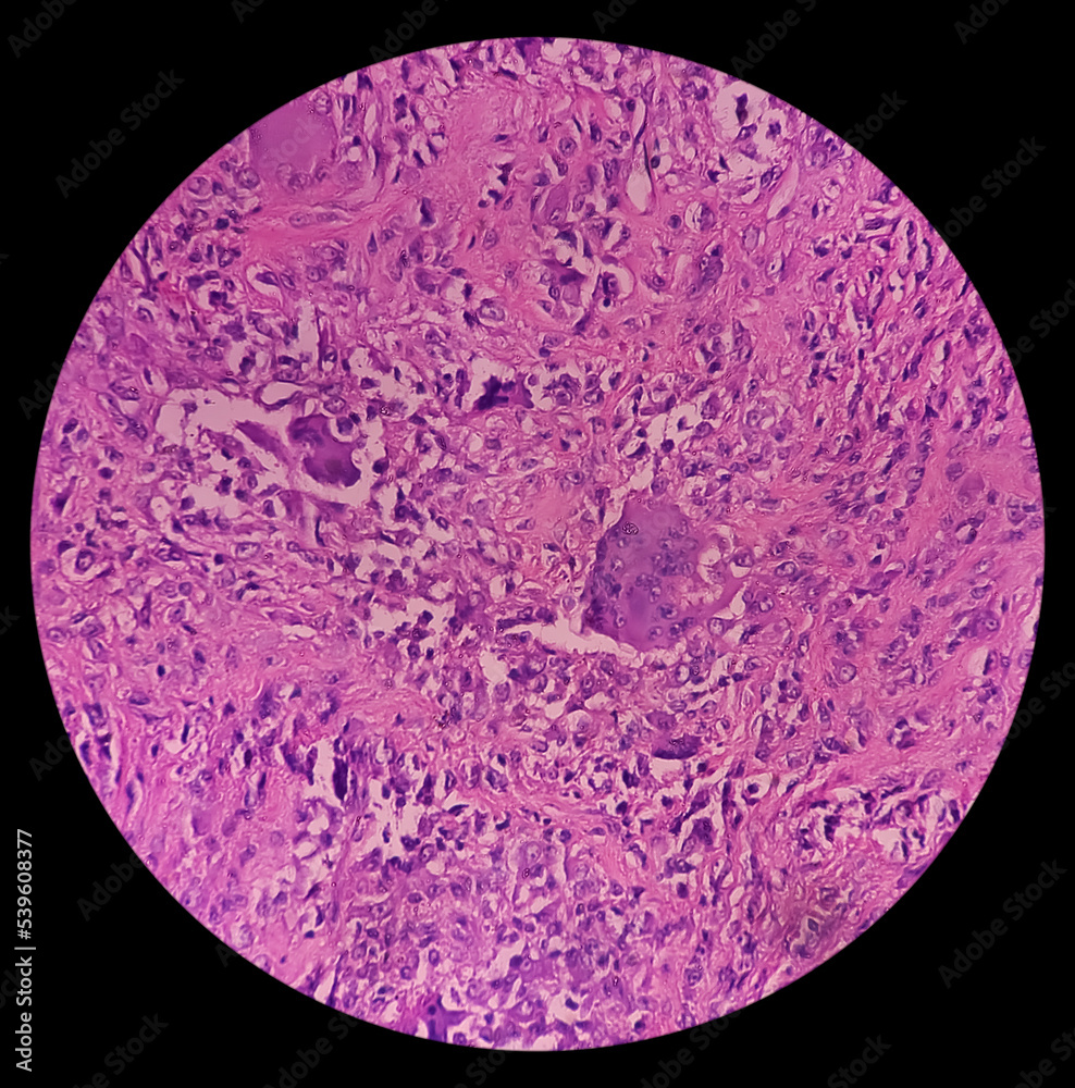 Finger(biopsy): Photomicrograph of giant cell tumor, microscopic show ...