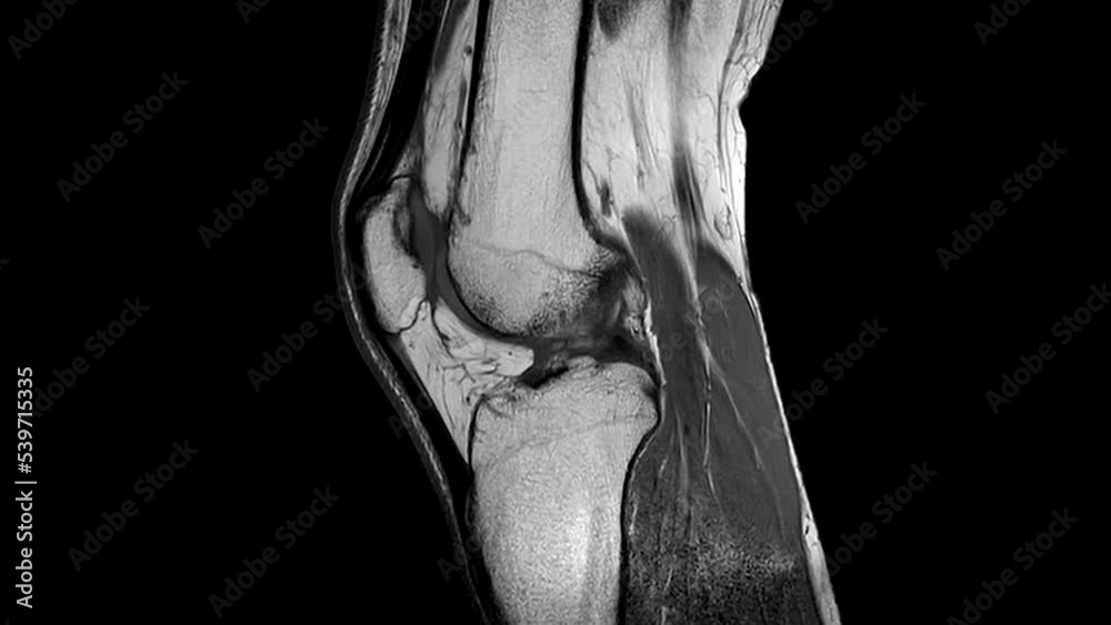Magnetic Resonance images of The Knee joint Sagittal Proton density ...