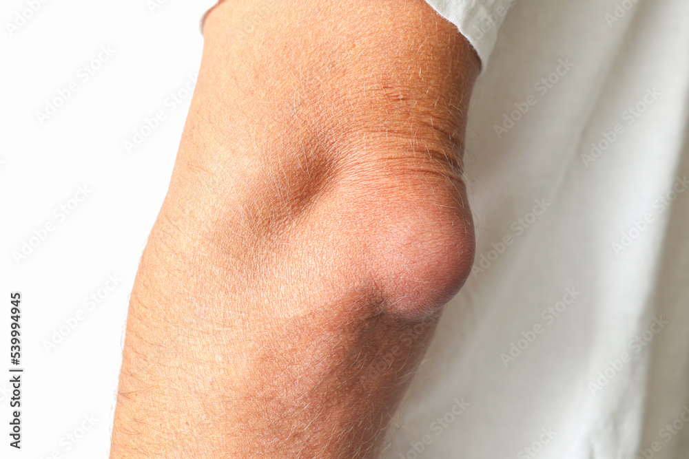 Fotografia do Stock: Man swelling erythematous lump pain elbow from ... Fotografia do Stock: Man swelling erythematous lump pain elbow from ...