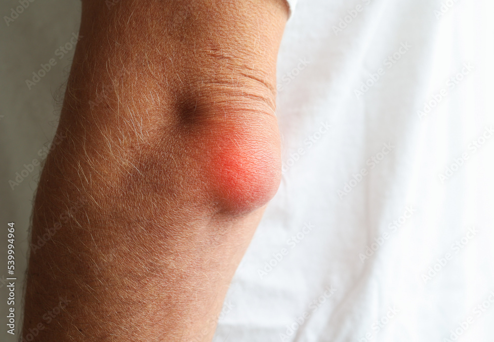 Man swelling erythematous lump pain elbow from Olecranon bursitis ... Man swelling erythematous lump pain elbow from Olecranon bursitis ...