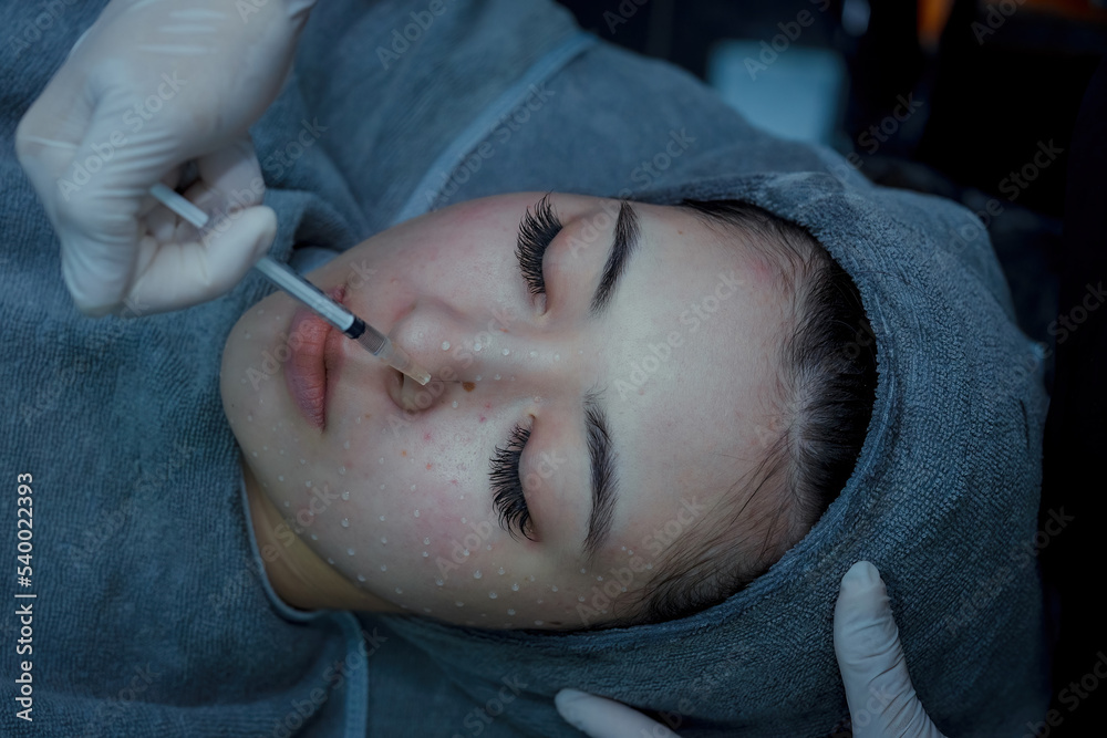 Needle mesotherapy. Microneedle meso therapy, treatment woman at the ...