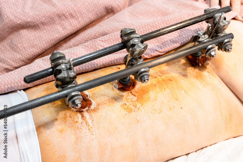 treated wounds around rods of external fixation device on hip and ...