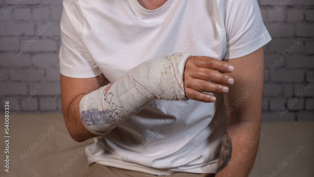 man with broken arm, distal radius fracture Stock Photo | Adobe Stock
