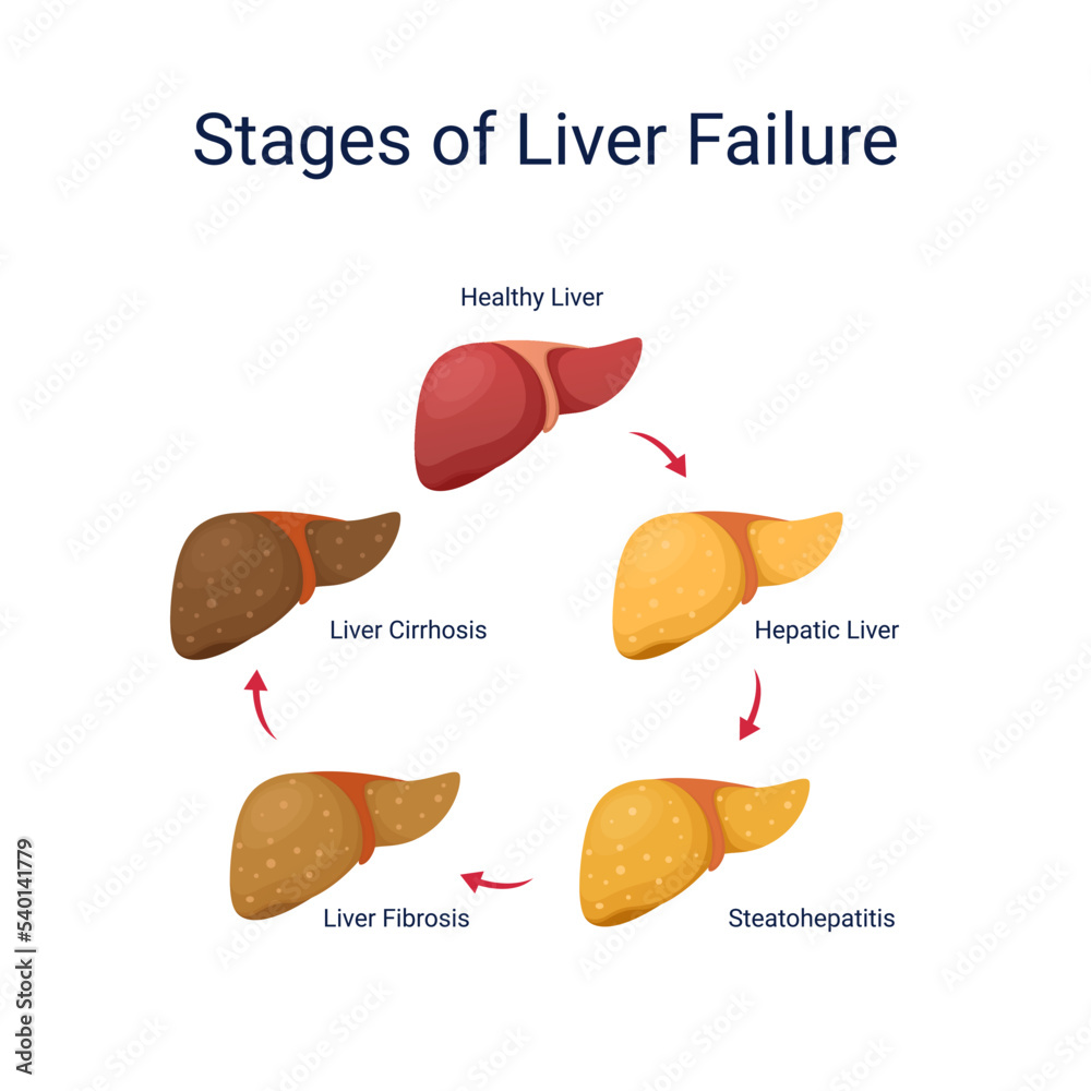 Liver diseases stage anatomy diagram vector illustration Stock Vector ...