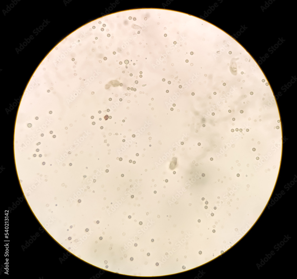 Red blood cells (RBC) in urine analysed by microscope. Stock Photo ...