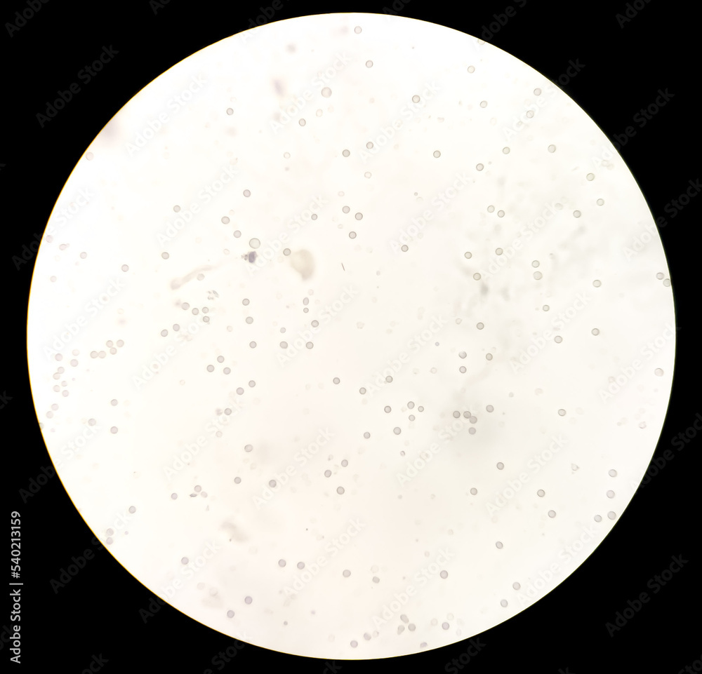 Red blood cells (RBC) in urine analysed by microscope. Stock Photo ...