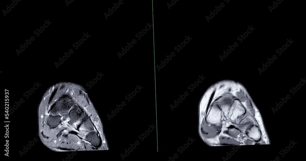 MRI of ankle joint for diagnosis tendon of ankle joint injury from ...