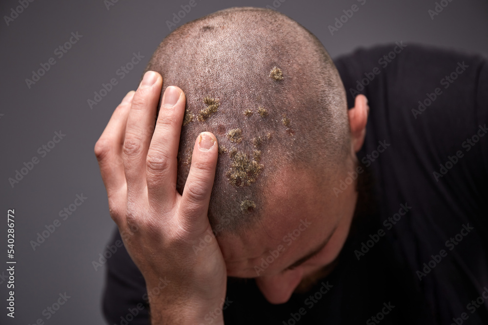 Man with dry flaky skin on his head with psoriasis and nail fungus on ...