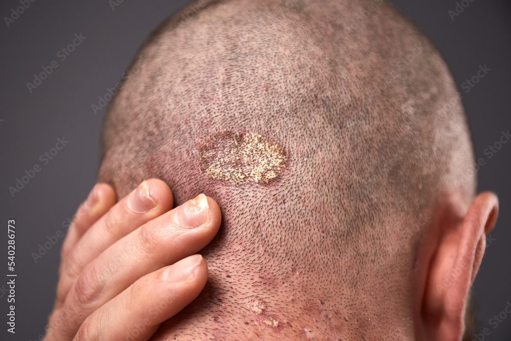 Man with dry flaky skin on his head with psoriasis and nail fungus on ...