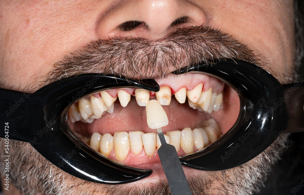 Determination of tooth color. Compatibility of tooth enamel color with ...