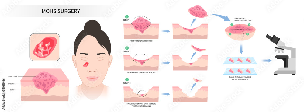 Microscopic Facial biopsy and Mohs surgery basal cell reconstruction ...