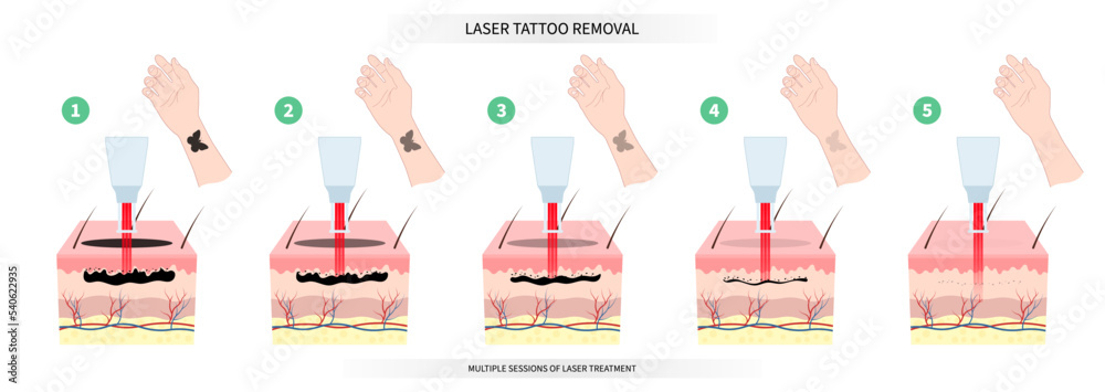 Vetor de Various stages of skin tattoo remove surgery on hand do Stock ...
