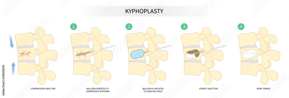 degeneration disk disease with kyphoplasty spine of dowager’s hump ...