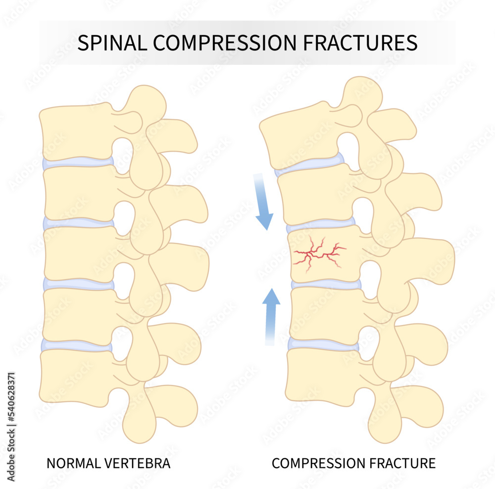 backbone vertebral column joint disease with kyphoplasty spine of ...