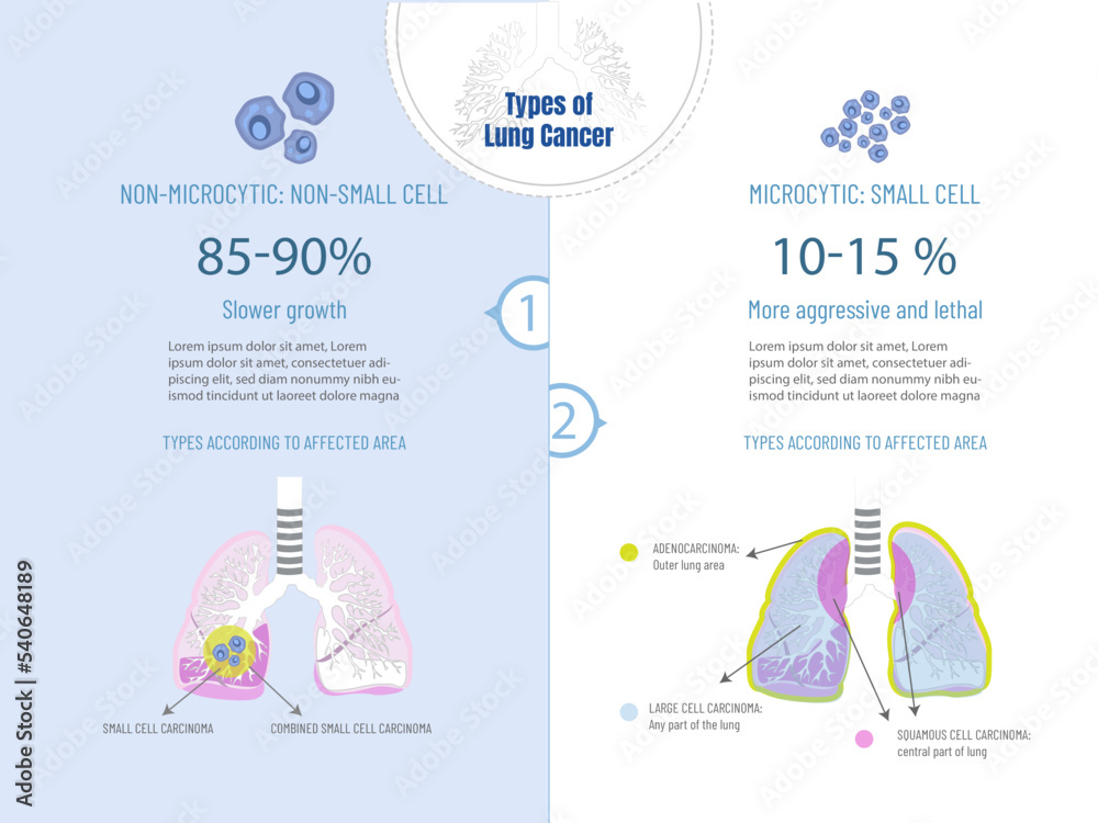 Types of lung cancer, non-small cell and small cell. Area of the lung ...