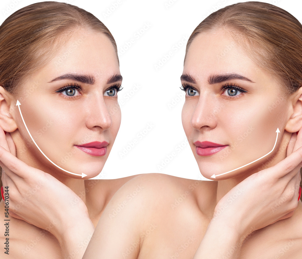 Woman before and after cheekbones shape correction. Stock Photo | Adobe ...