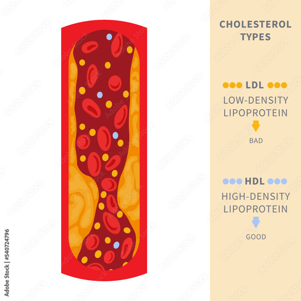 Plakat Narrowed blood vessel with cholesterol plaque buildup. Artery ...