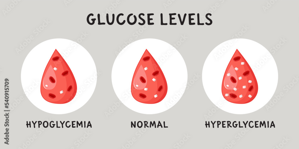 Glucose blood level infographic. Hypoglycemia, hyperglycemia and normal ...
