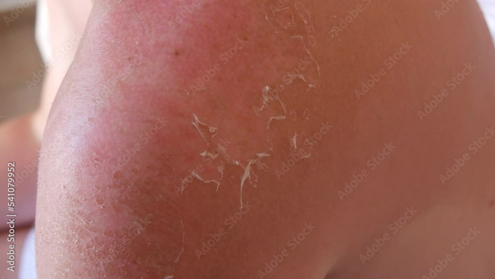 Video „sunburn Closeup Of Peeling Sunburned Skin On Back And Shoulder