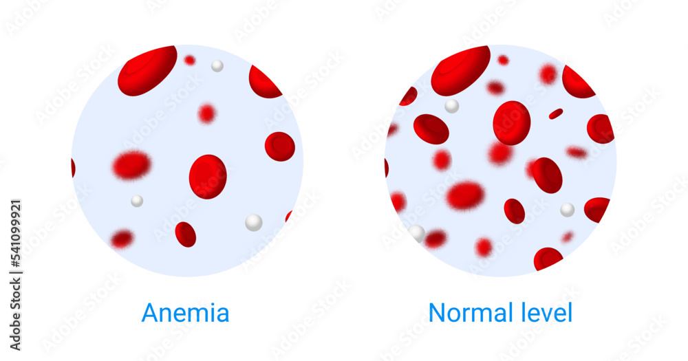 Anemia problem circulatory iron body diagram background. Anaemia ...