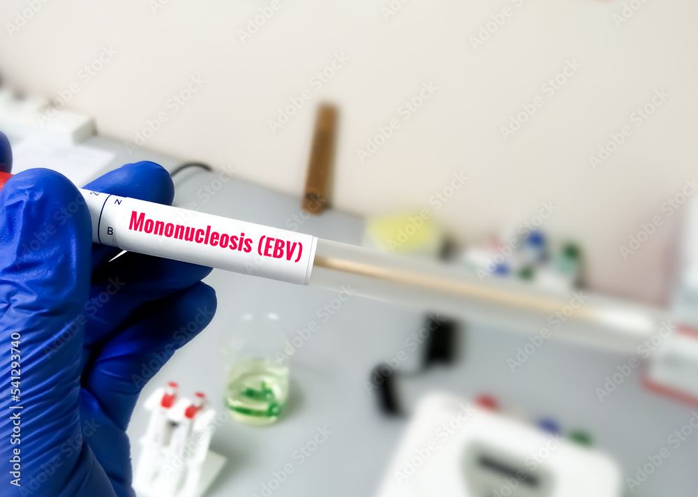 Scientist hold saliva sample for Infectious mononucleosis (mono) test ...