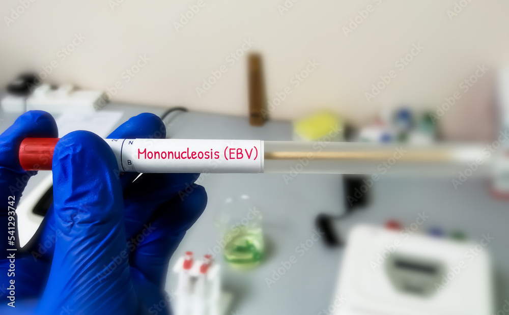 Scientist hold saliva sample for Infectious mononucleosis (mono) test ...