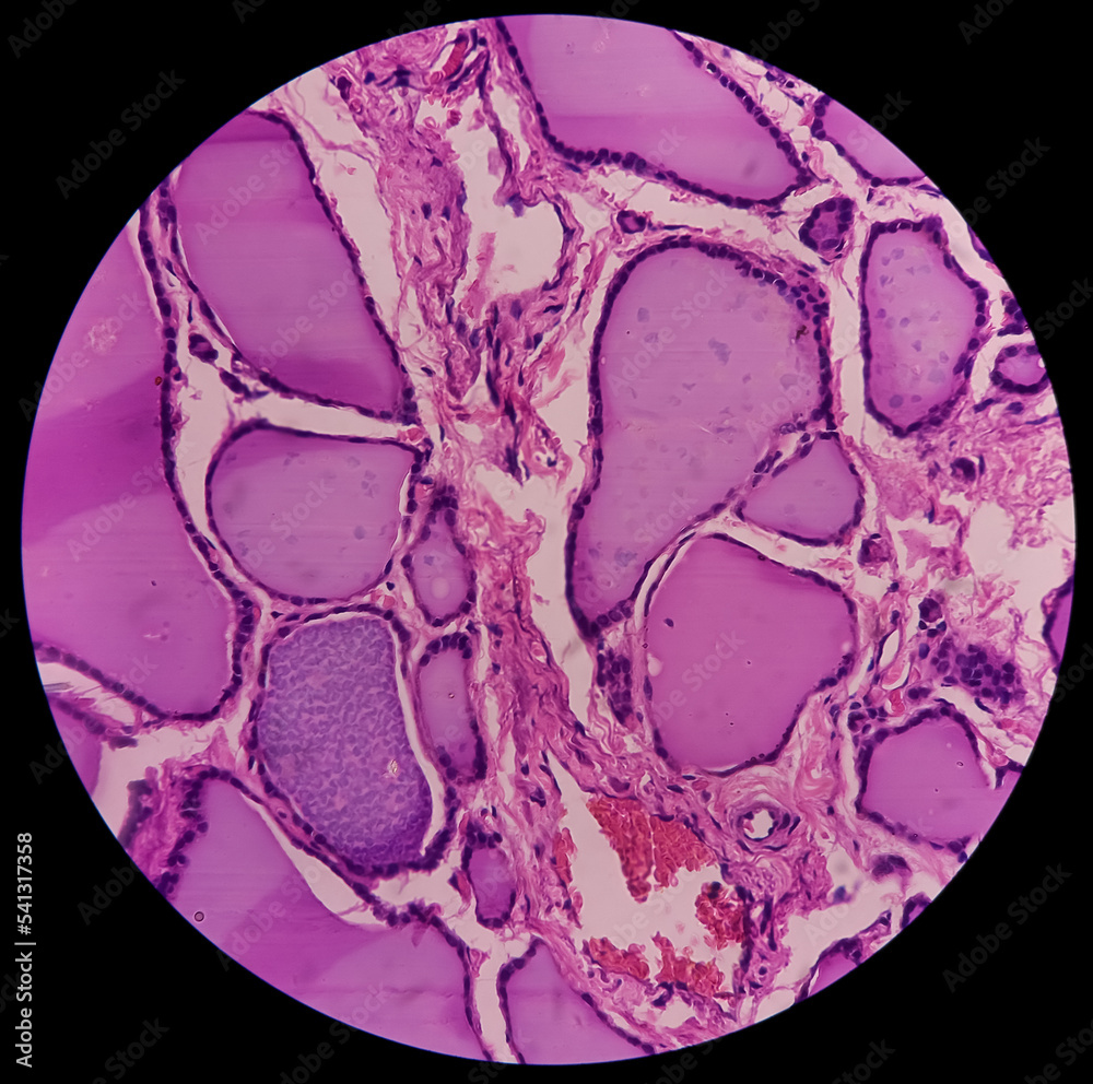 Multinodular goitre. Show thyroid tissue, follicles of different size ...