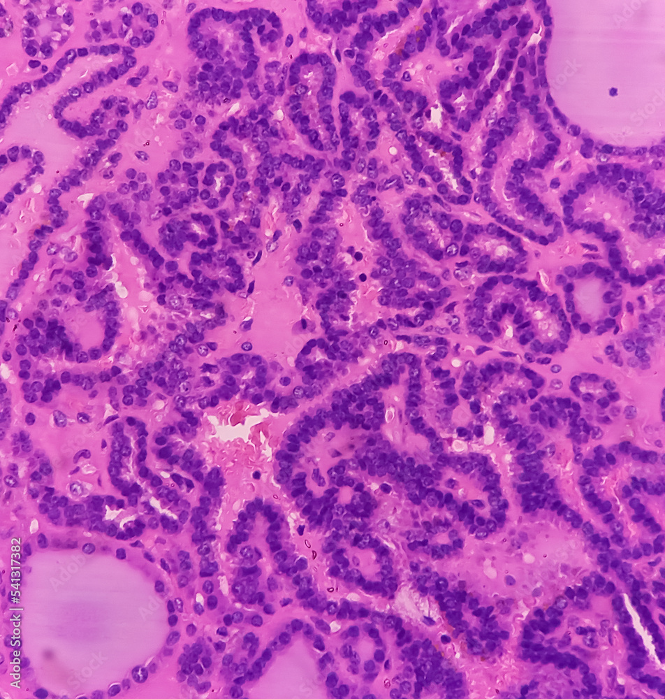 Multinodular goitre. Show thyroid tissue, follicles of different size ...