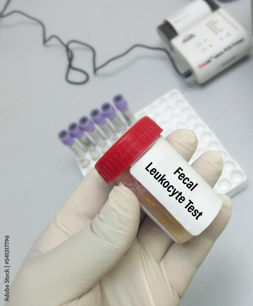 Stool sample in a container for Fecal leukocyte test to diagnosis of ...